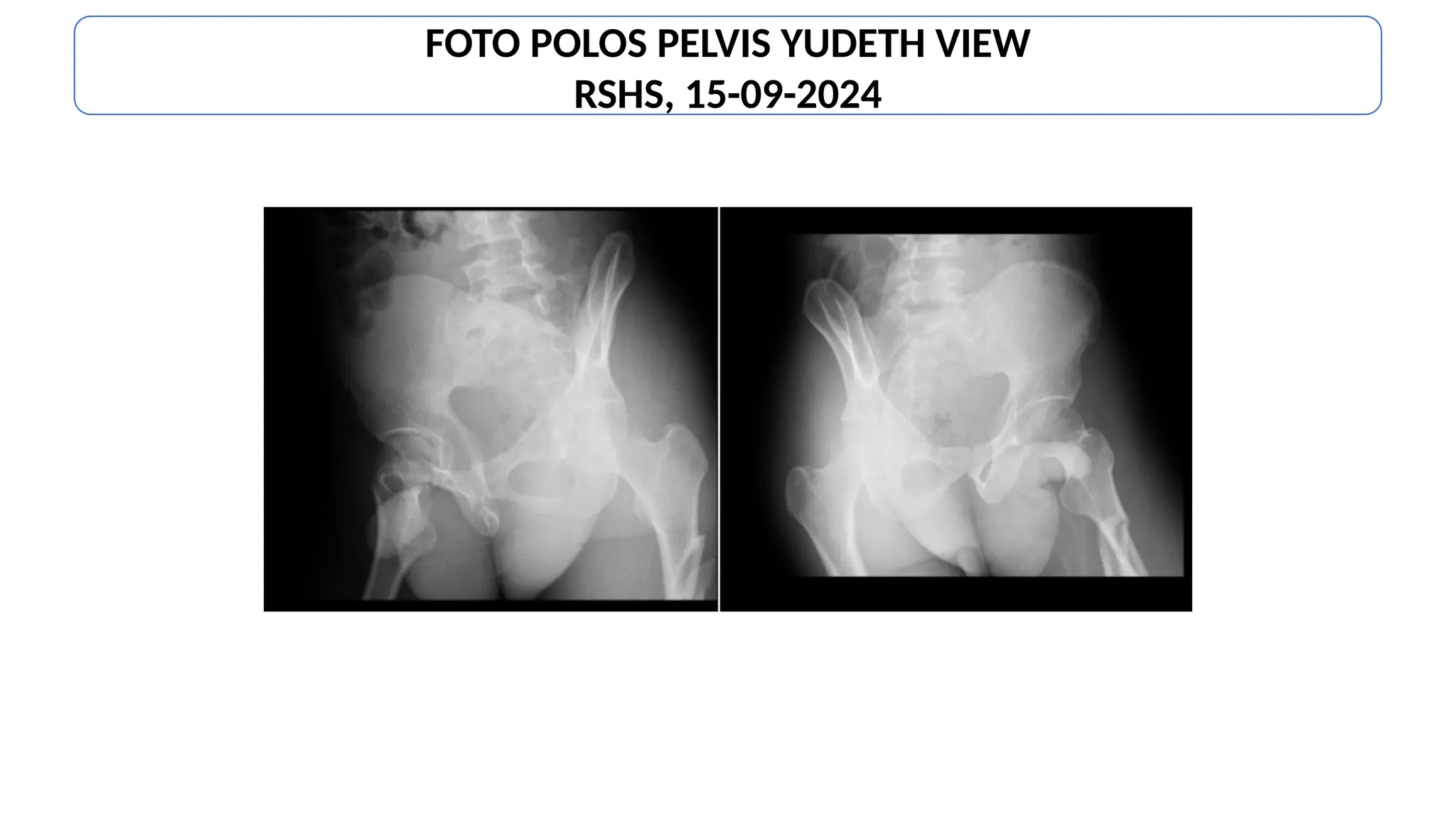 Pelvic ring injury Tile classification A2 dengan hemodynamic stabil ...