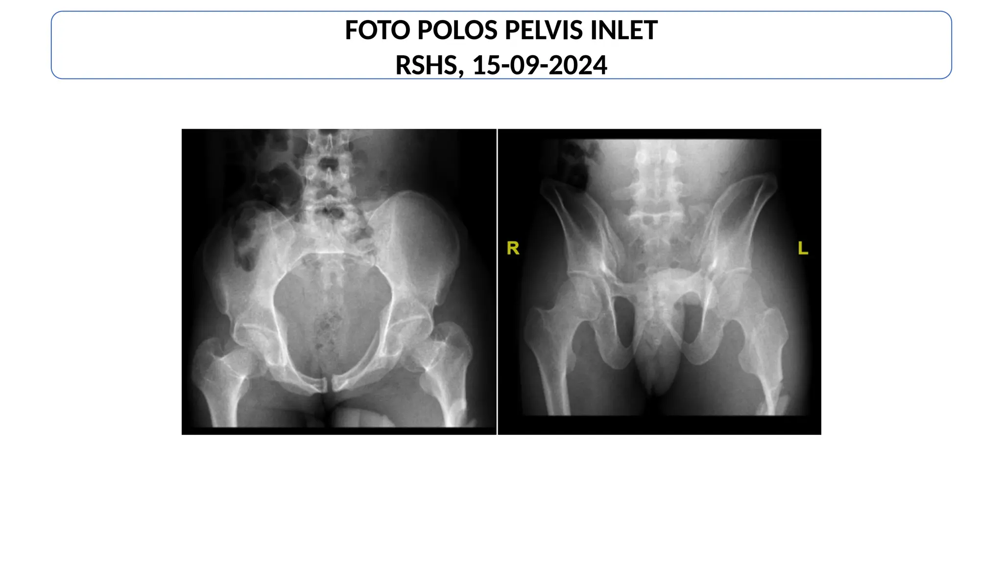 Pelvic ring injury Tile classification A2 dengan hemodynamic stabil ...