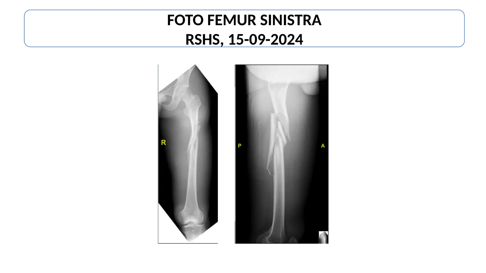 Pelvic ring injury Tile classification A2 dengan hemodynamic stabil ...