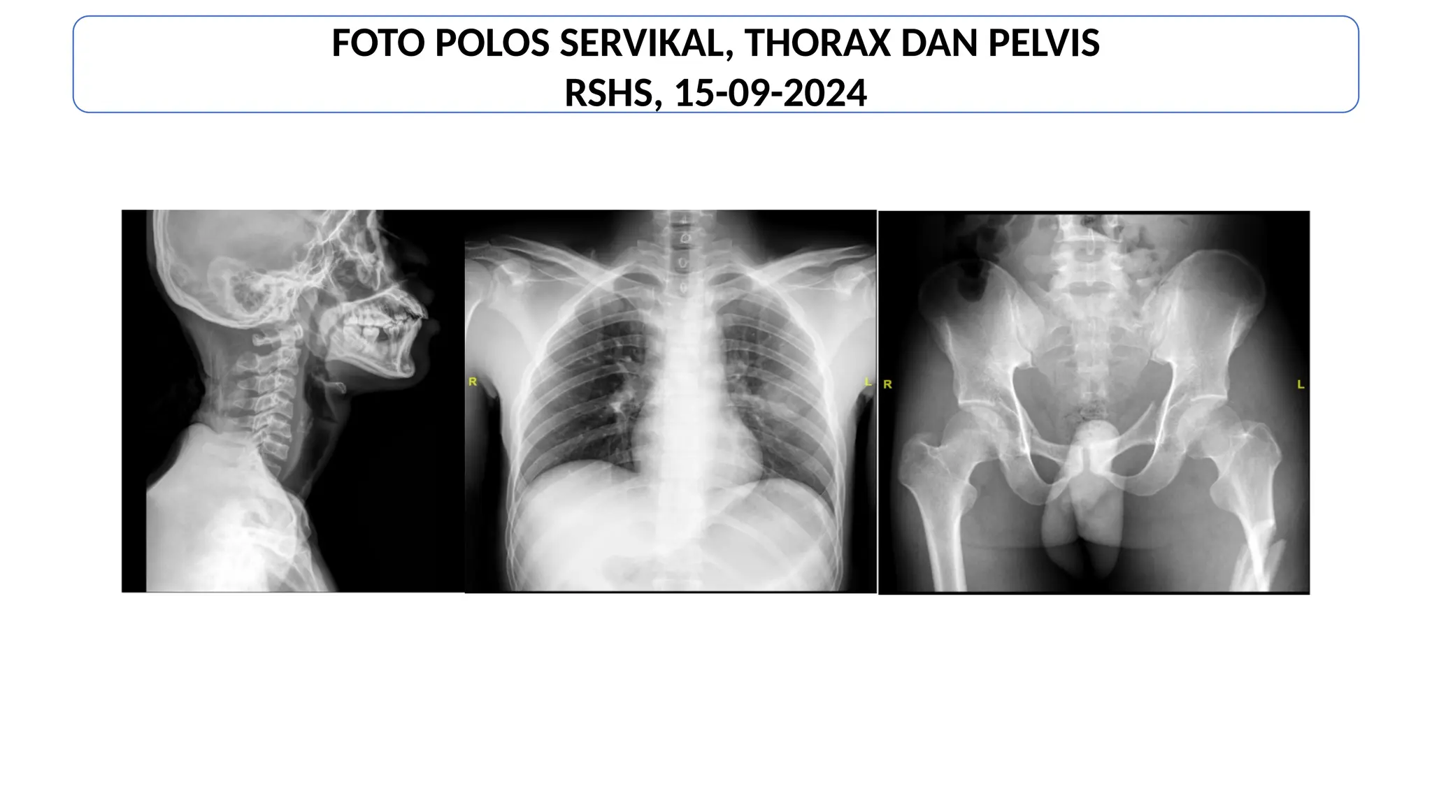 Pelvic ring injury Tile classification A2 dengan hemodynamic stabil ...