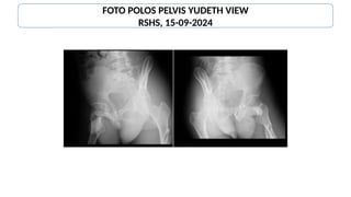 Pelvic ring injury Tile classification A2 dengan hemodynamic stabil ...
