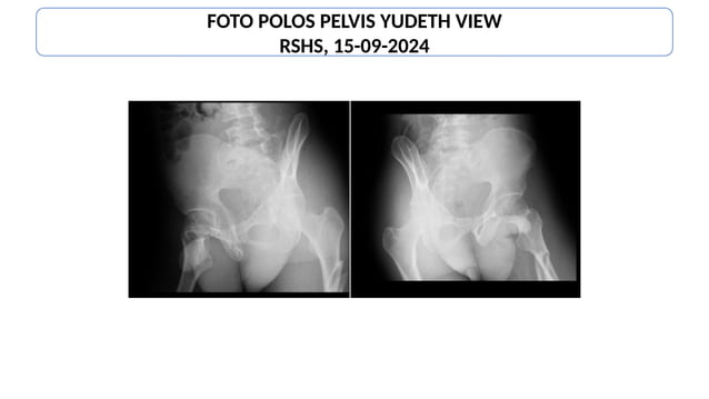 Pelvic ring injury Tile classification A2 dengan hemodynamic stabil ...