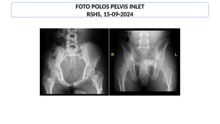 Pelvic ring injury Tile classification A2 dengan hemodynamic stabil ...
