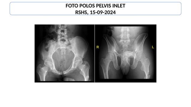 Pelvic ring injury Tile classification A2 dengan hemodynamic stabil ...