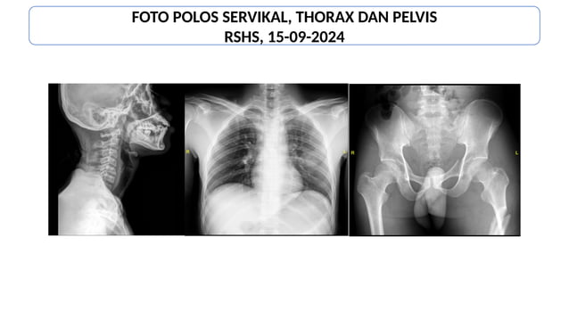 Pelvic ring injury Tile classification A2 dengan hemodynamic stabil ...