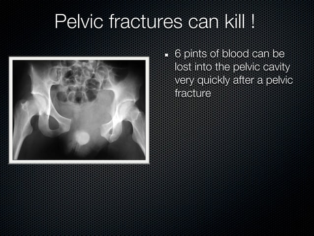 Pelvic splinting | PPT