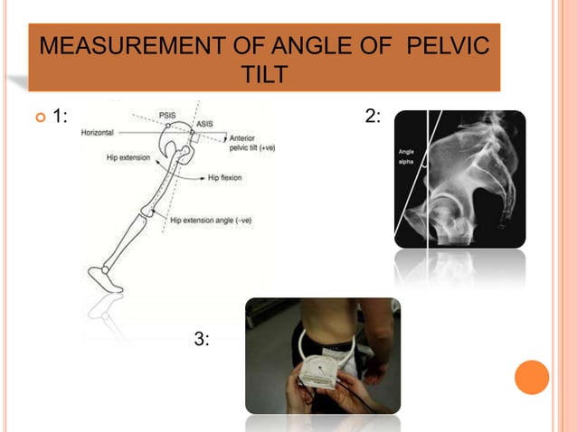 Pelvic tilt | PPTX