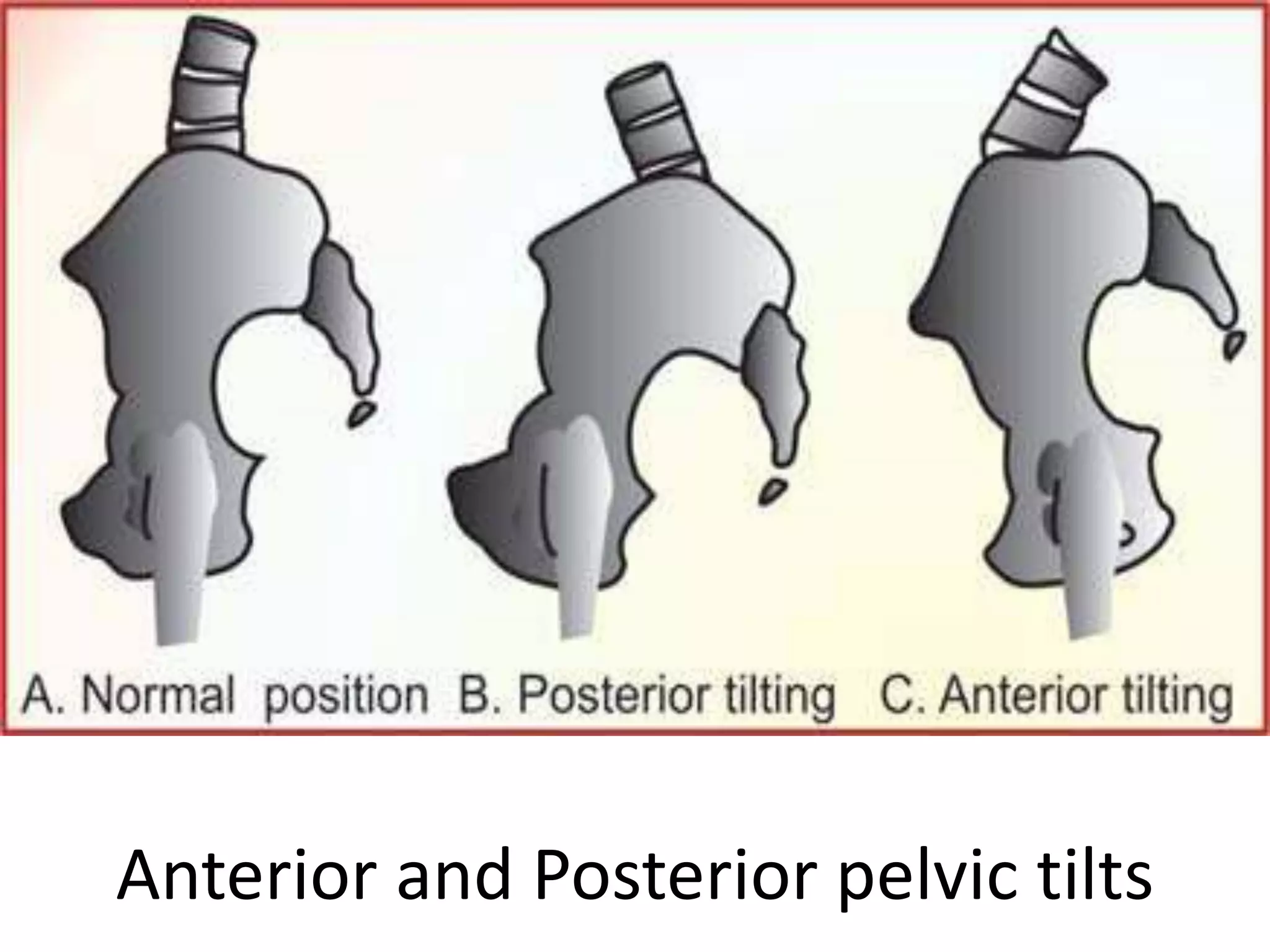 Pelvic tilt | PPTX