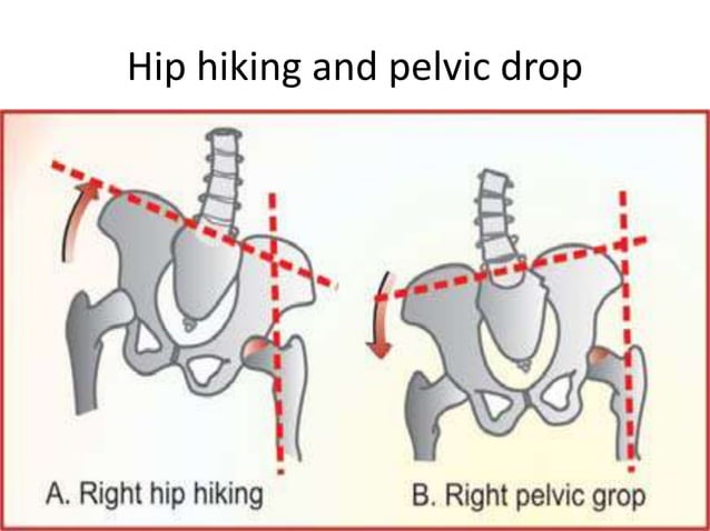 Pelvic tilt | PPTX