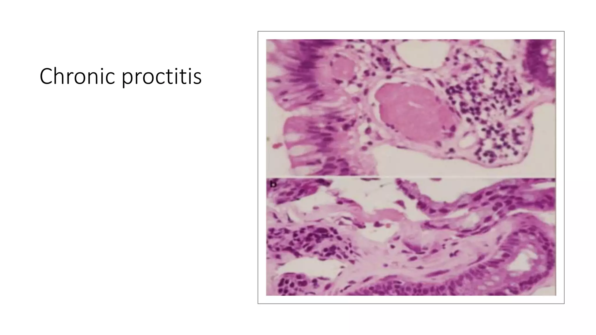 pelvic toxicities management (2).pptx