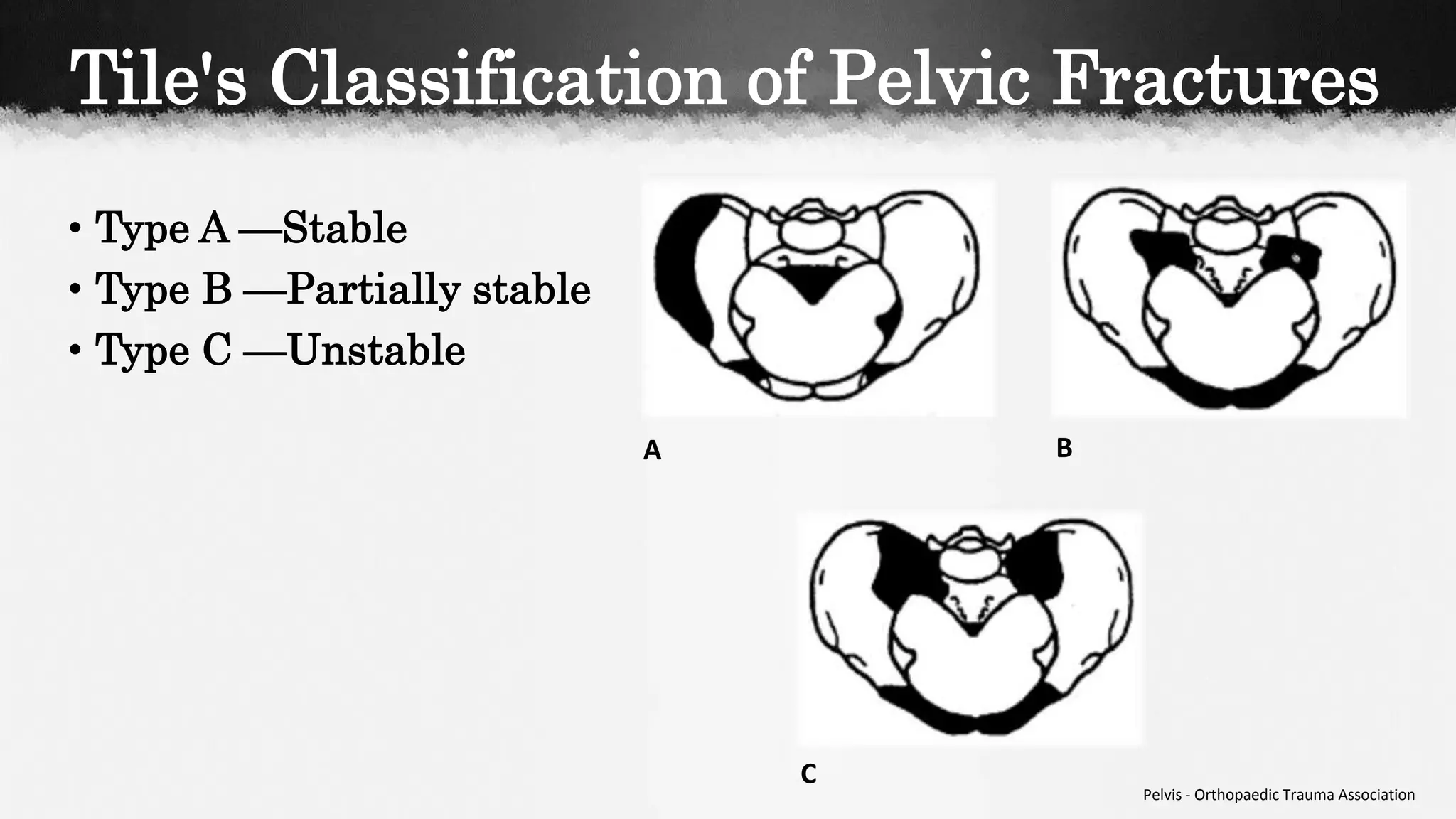 Pelvic trauma | PPTX