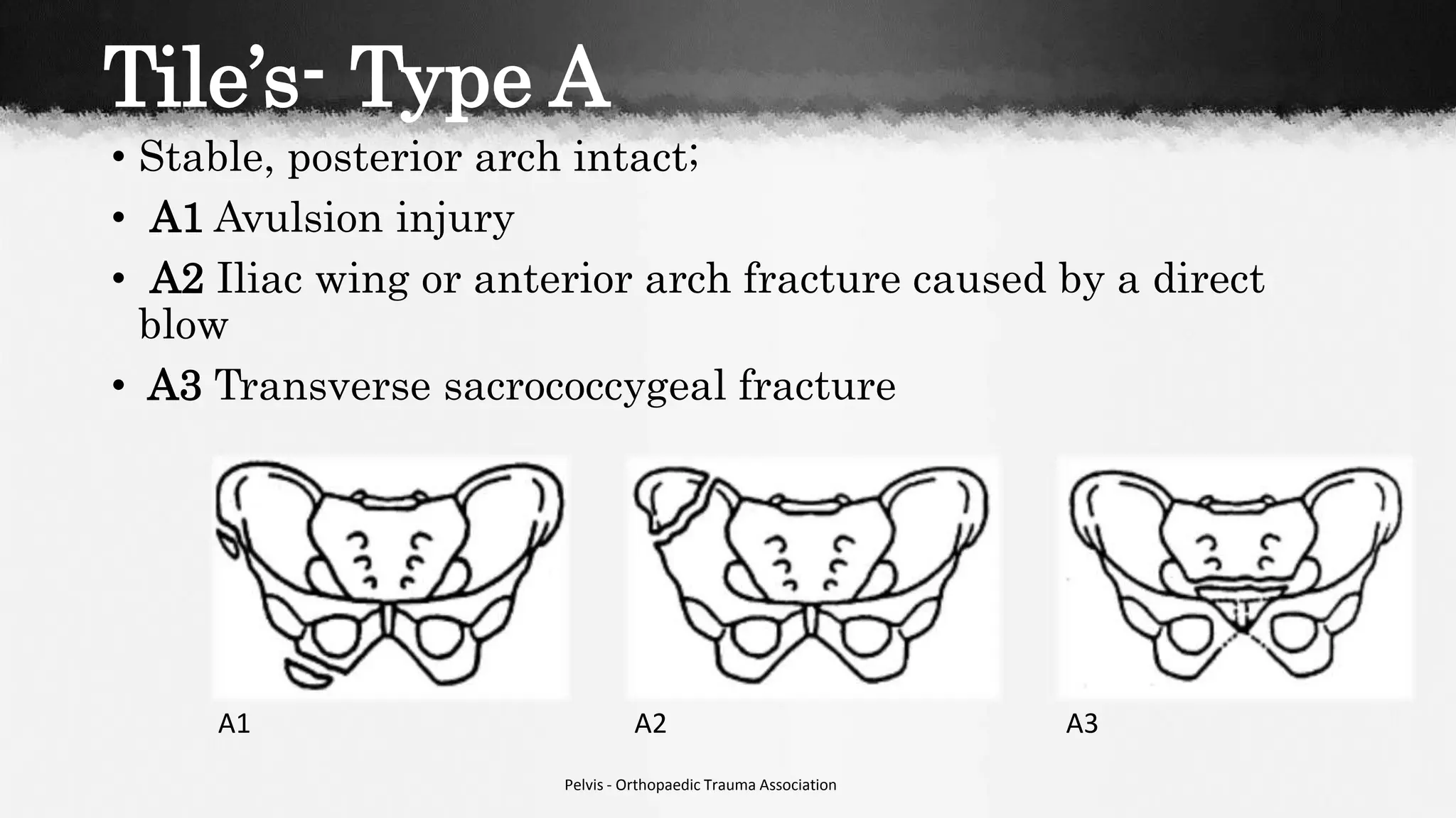 Pelvic trauma | PPTX