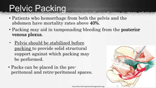 Pelvic trauma | PPTX