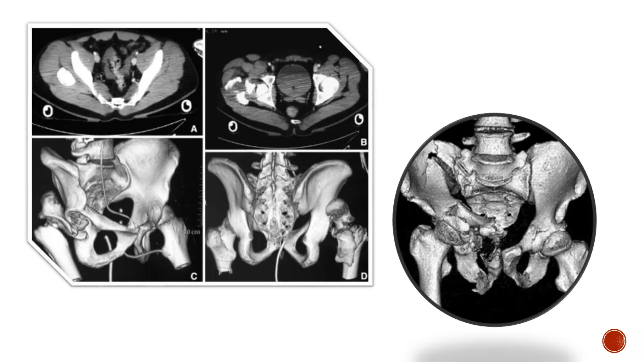 Pelvic trauma | PPTX