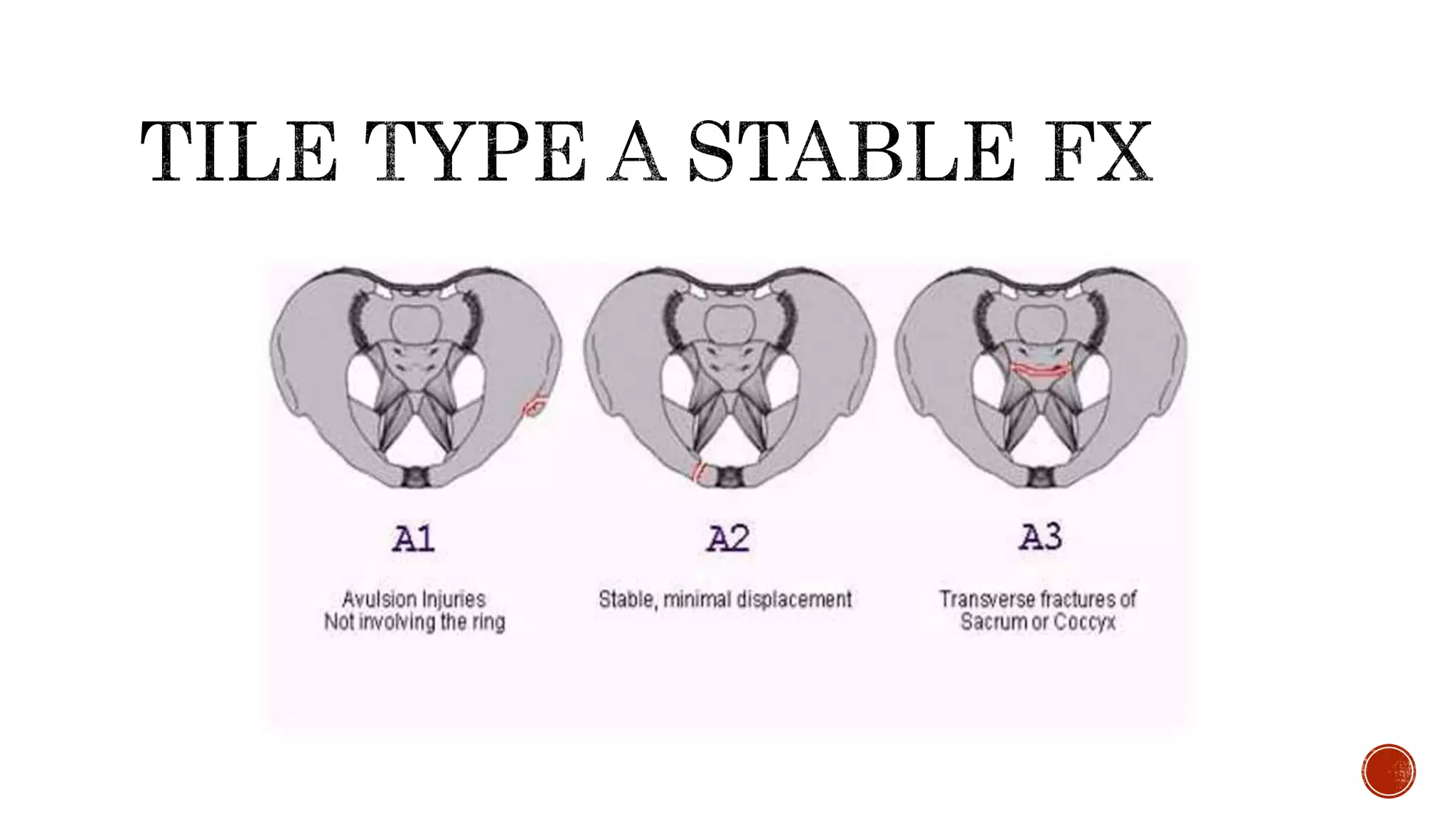 Pelvic trauma | PPTX