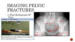 Pelvic trauma | PPTX