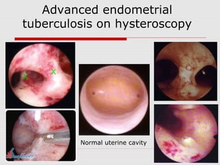 Pelvic tuberculosis and infertility trivandrum 31.8.13 | Infertility ...