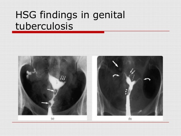 Pelvic tuberculosis and infertility trivandrum 31.8.13