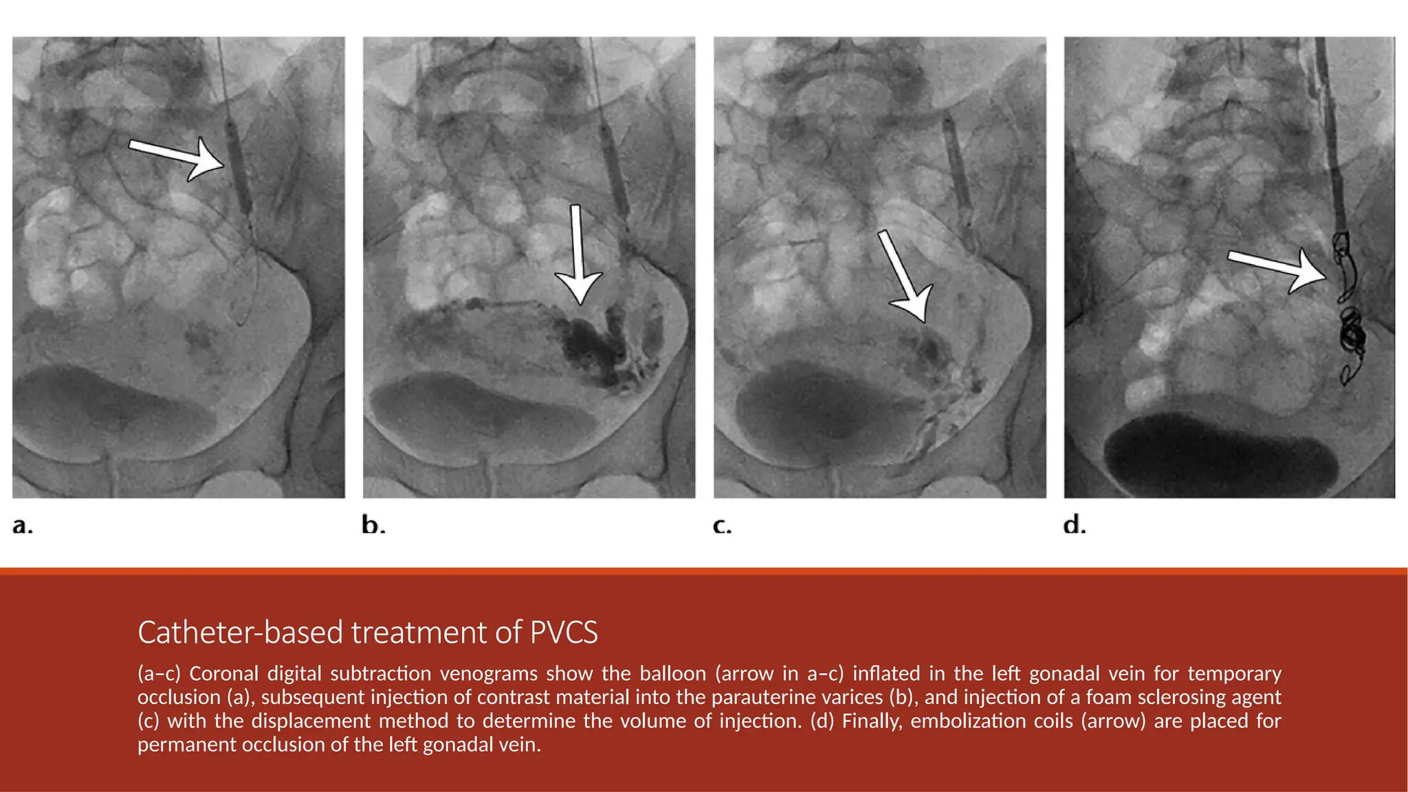 Pelvic venous congestion syndrome (PVCS) | PPTX