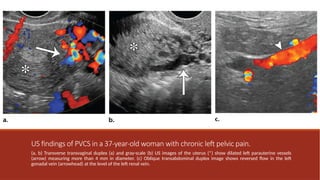 Pelvic venous congestion syndrome (PVCS) | PPTX