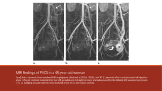 Pelvic venous congestion syndrome (PVCS) | PPTX