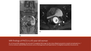 Pelvic venous congestion syndrome (PVCS) | PPTX