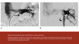 Pelvic venous congestion syndrome (PVCS) | PPTX