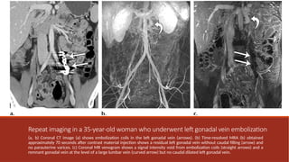 Pelvic venous congestion syndrome (PVCS) | PPTX