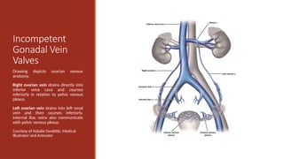 Pelvic venous congestion syndrome (PVCS) | PPTX