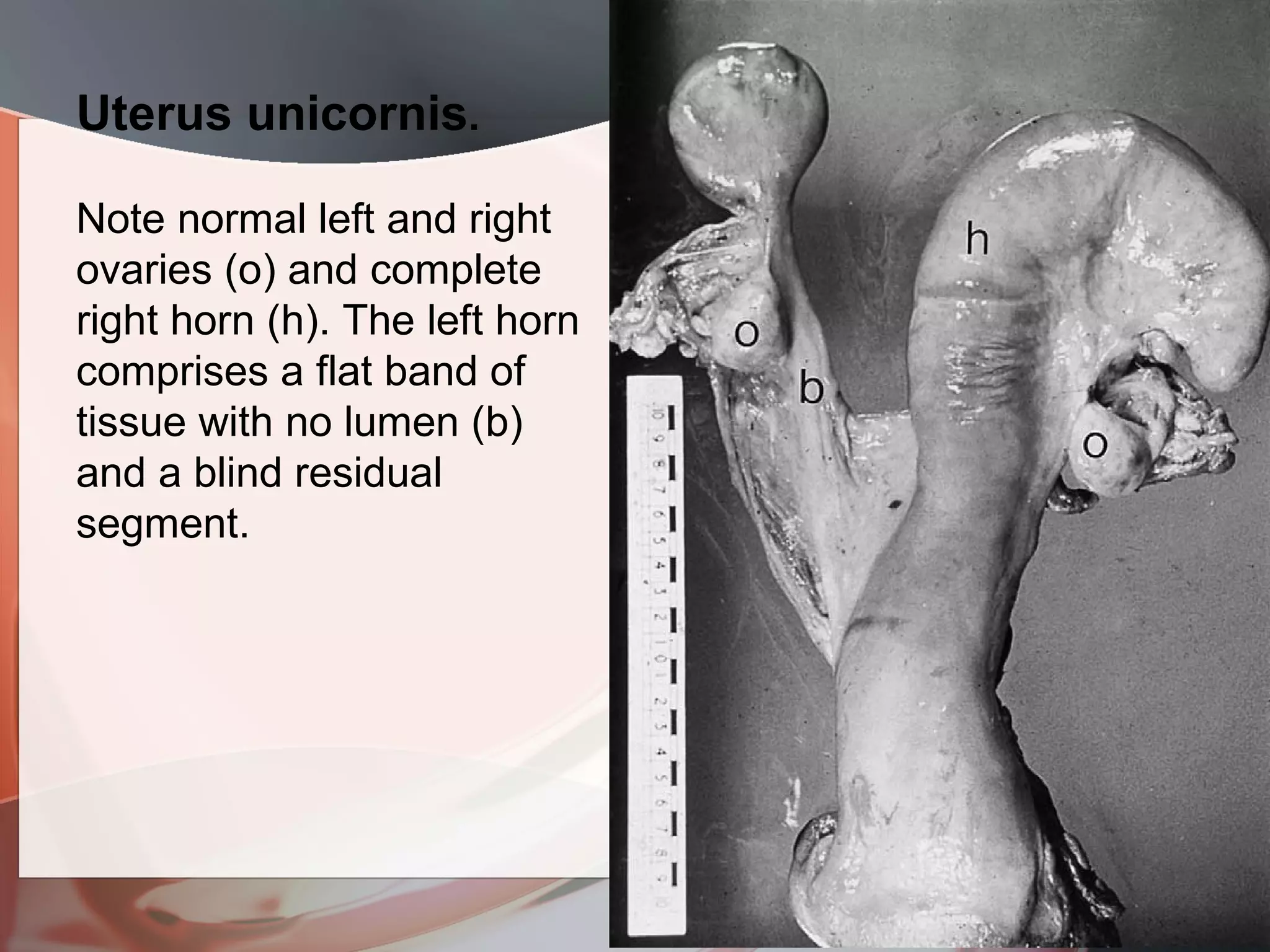 Pelvimetry, pelvic abnormalities,congenital defects of female rep.tract ...
