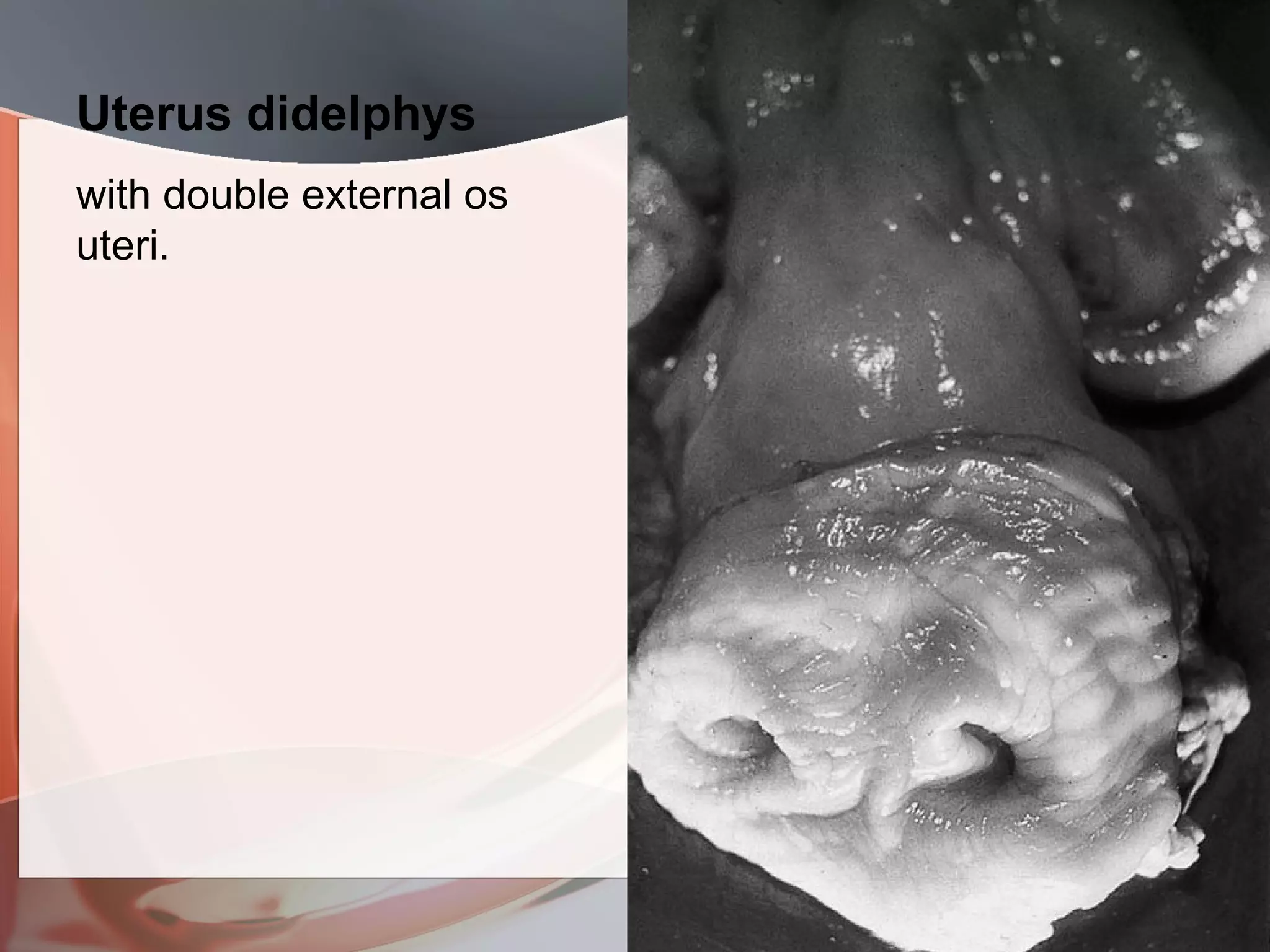 Pelvimetry, pelvic abnormalities,congenital defects of female rep.tract ...