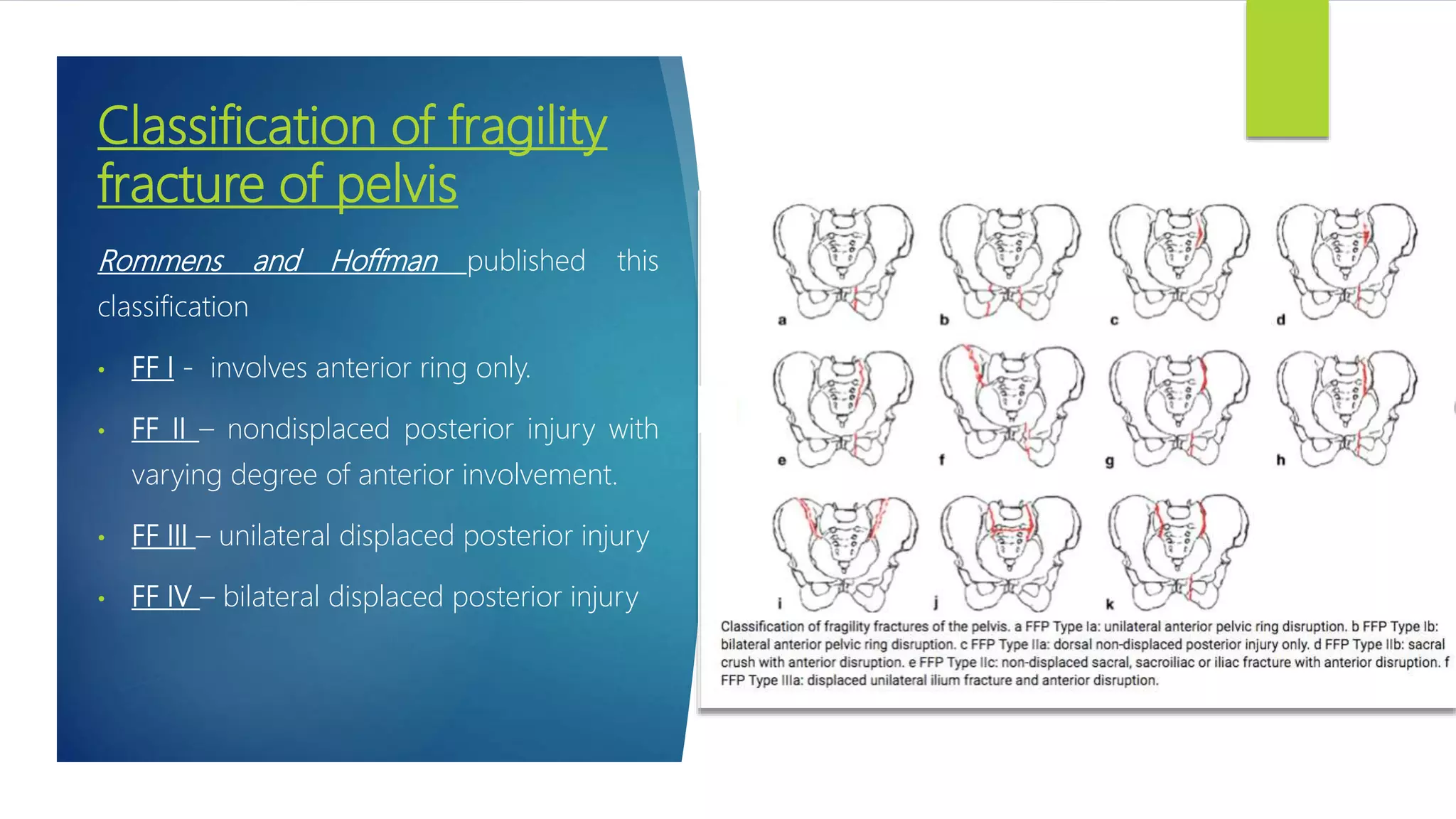 Pelvis fracture dislocation | PPTX