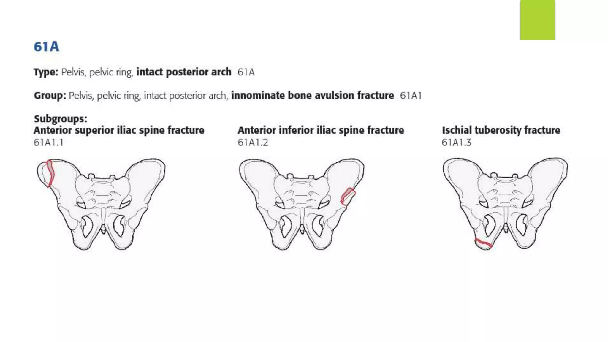 Pelvis fracture dislocation | PPTX