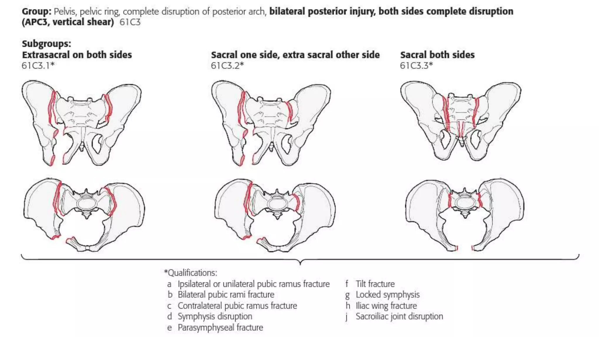 Pelvis fracture dislocation | PPTX
