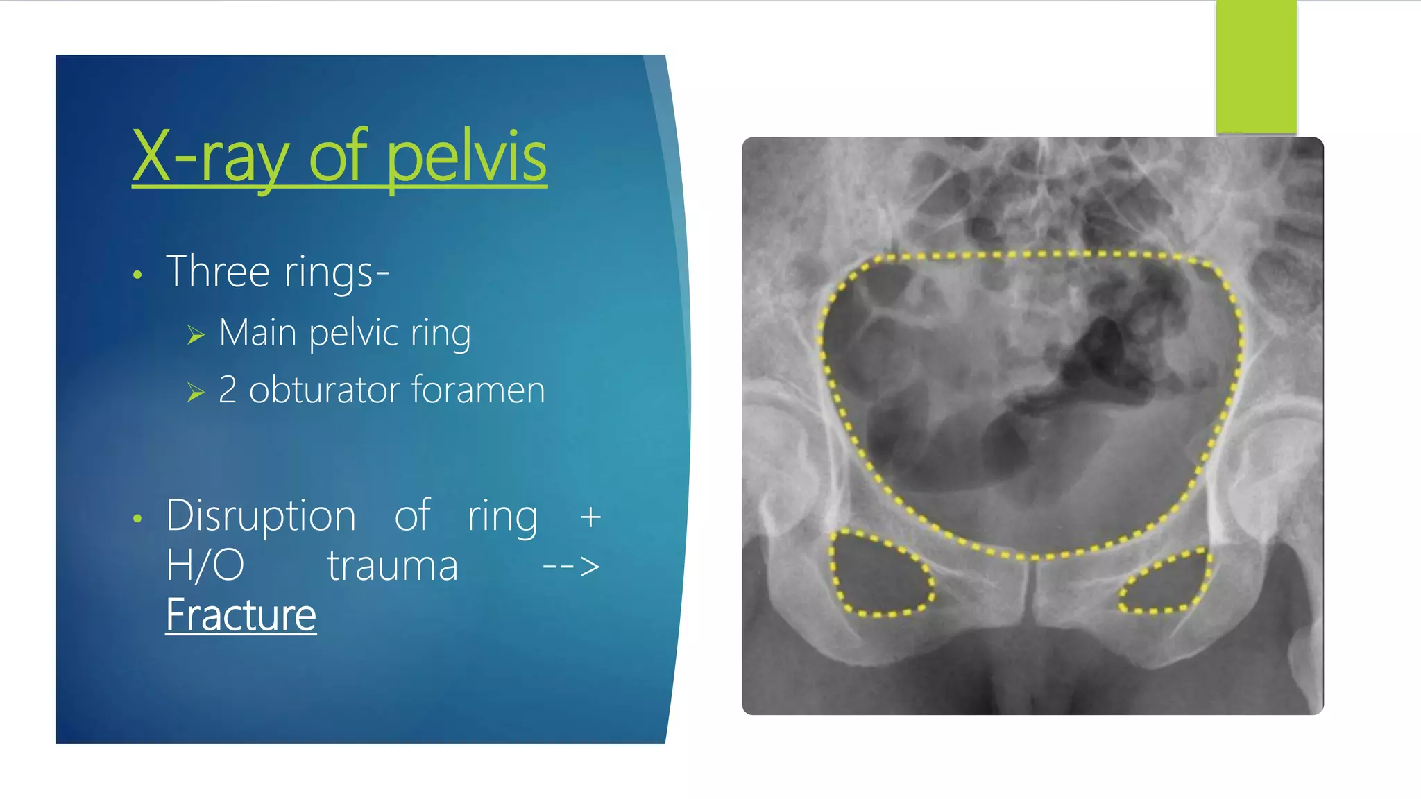 Pelvis fracture dislocation | PPTX