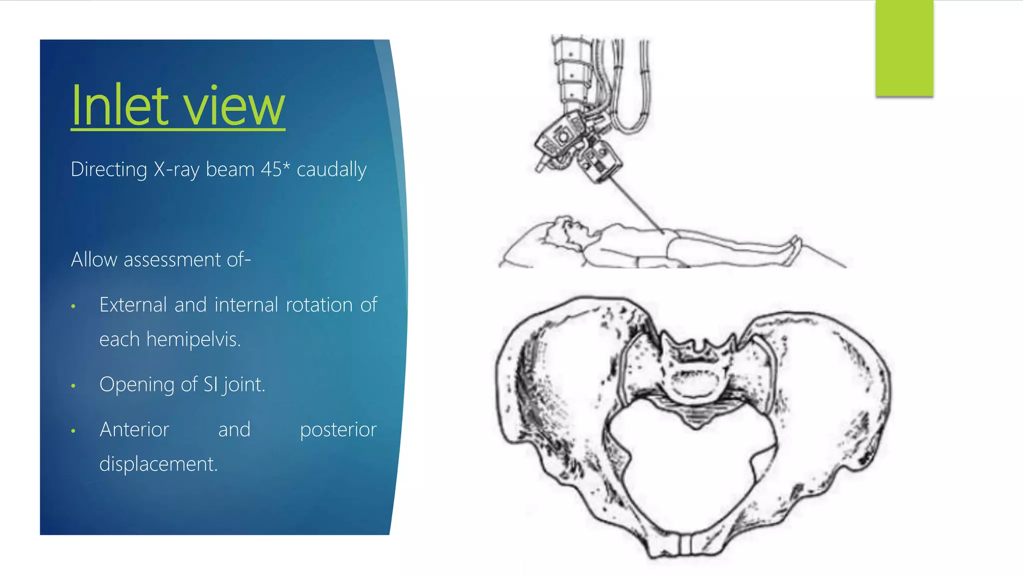 Pelvis fracture dislocation | PPTX