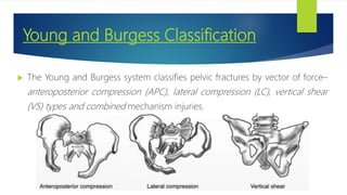 Pelvis fracture dislocation | PPTX