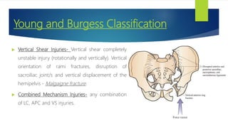 Pelvis fracture dislocation | PPTX