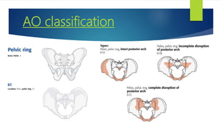 Pelvis fracture dislocation | PPTX