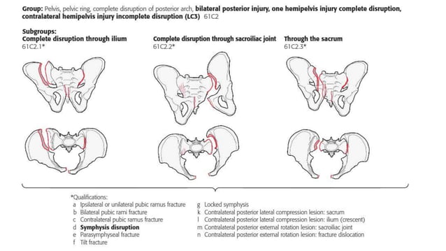 Pelvis fracture dislocation | PPTX