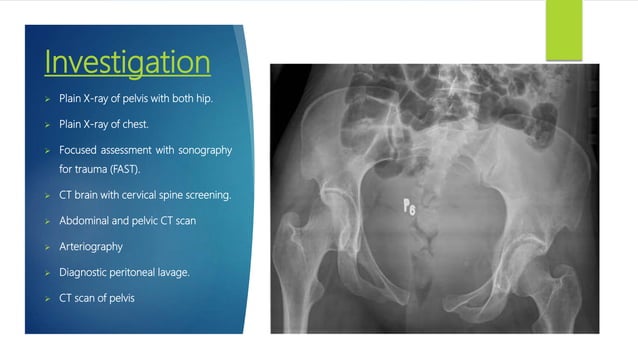 Pelvis fracture dislocation | PPTX