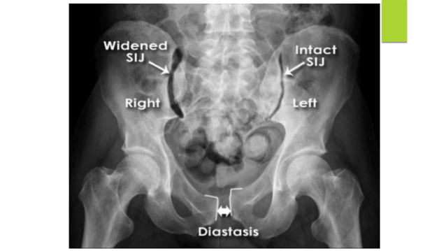 Pelvis fracture dislocation | PPTX
