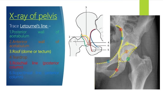 Pelvis fracture dislocation | PPTX
