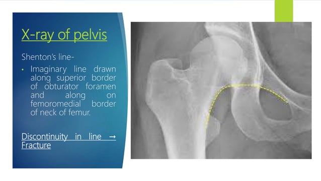 Pelvis fracture dislocation | PPTX