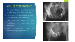 Pelvis fracture dislocation | PPTX