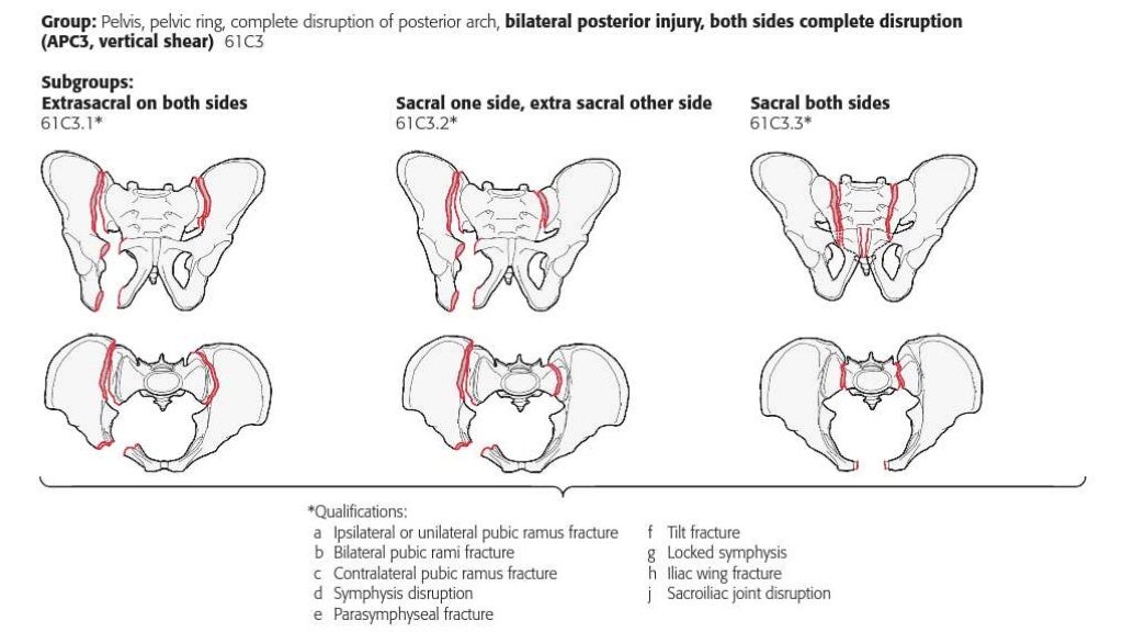 Pelvis fracture dislocation