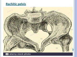 Rachitic Pelvis