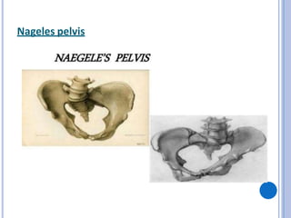 Naegeles Pelvis