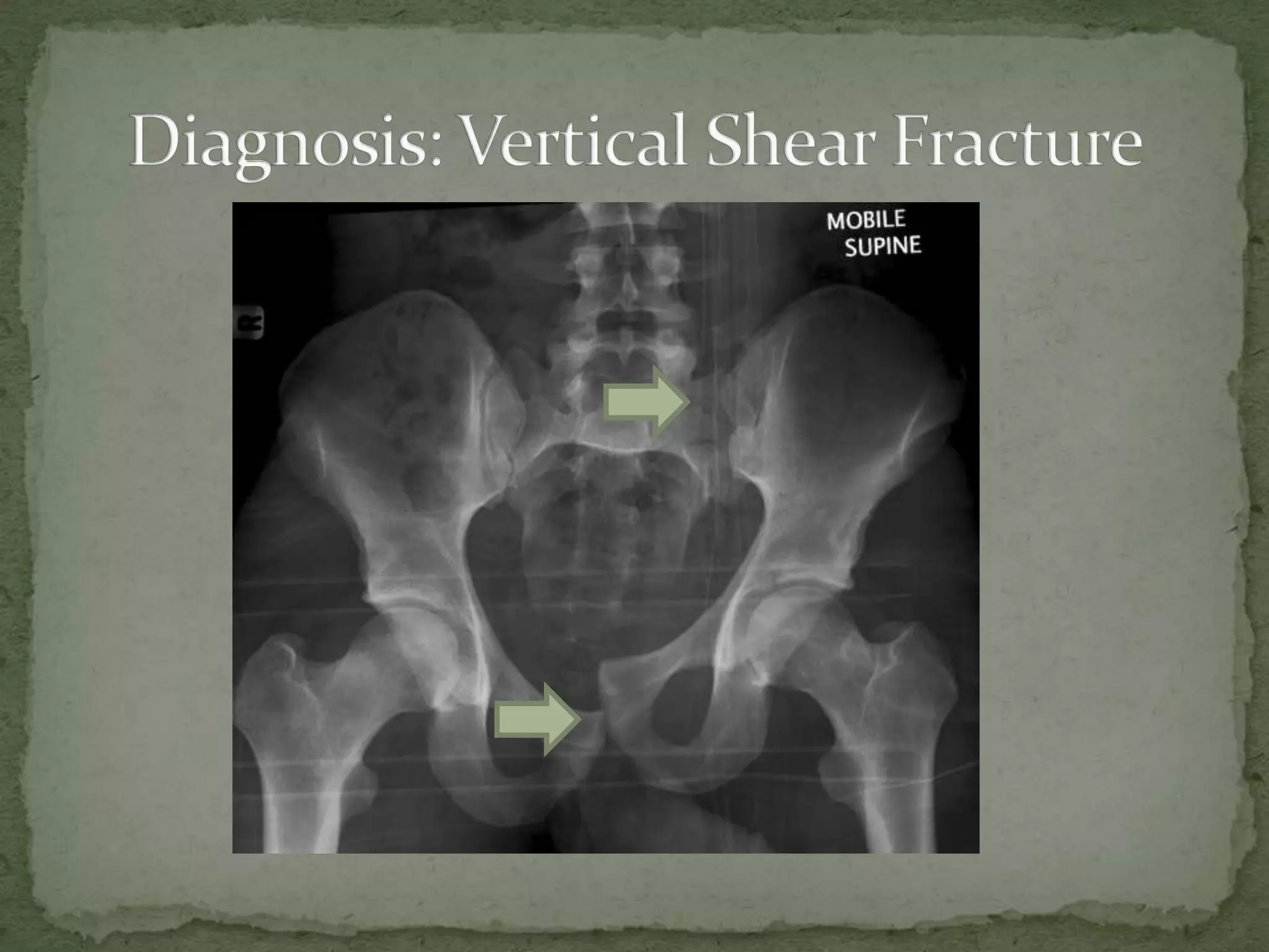 Vertical Shear Pelvic Fracture | PPTX