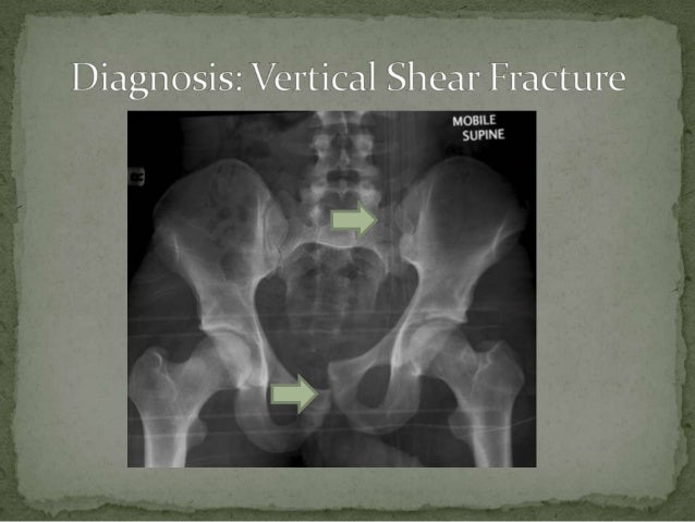 Vertical Shear Pelvic Fracture